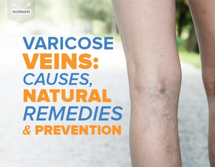 Varicose Veins: Causes, Natural Remedies and Prevention
