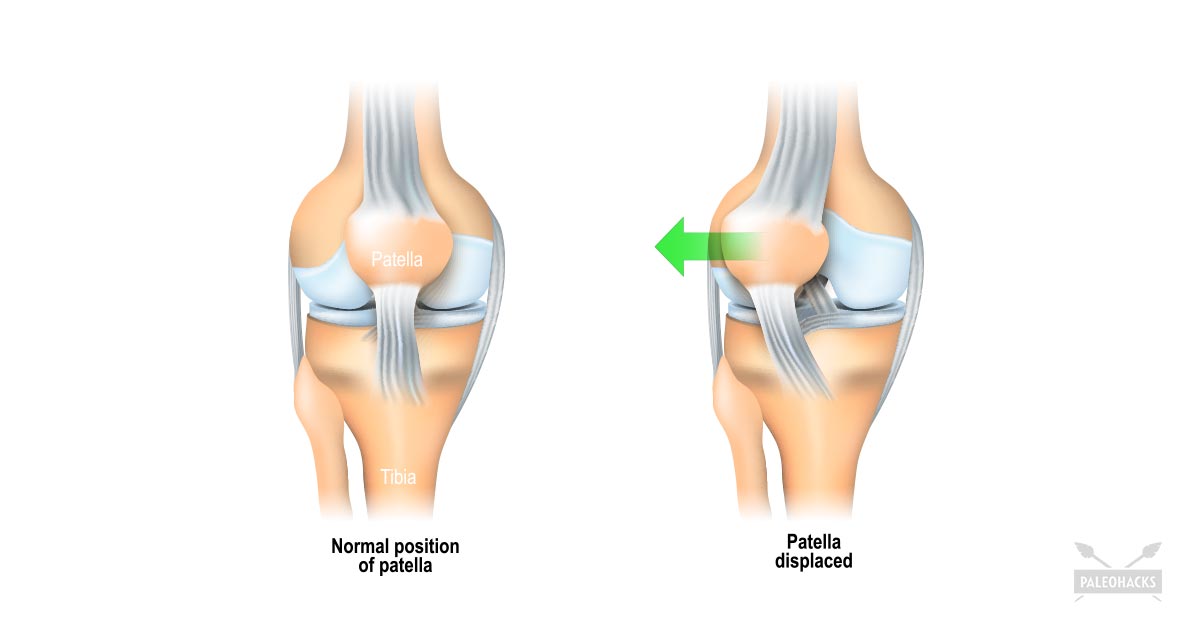 7 Exercises to Fix Knee Pain (And Prevent Patellar Tracking Disorder) 7 Exercises to Fix Knee Pain (And Prevent Patellar Tracking Disorder)